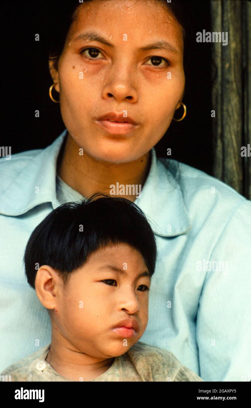 Quyen ist vier. Sie hat Mikrozephalie. Quens Vater, Nyguyen Van Quach ...