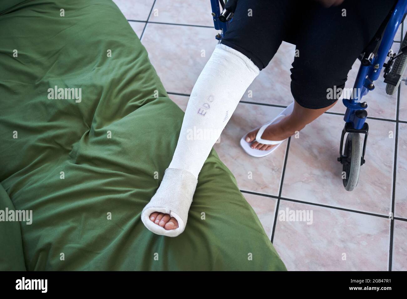 Broken leg cast -Fotos und -Bildmaterial in hoher Auflösung – Alamy