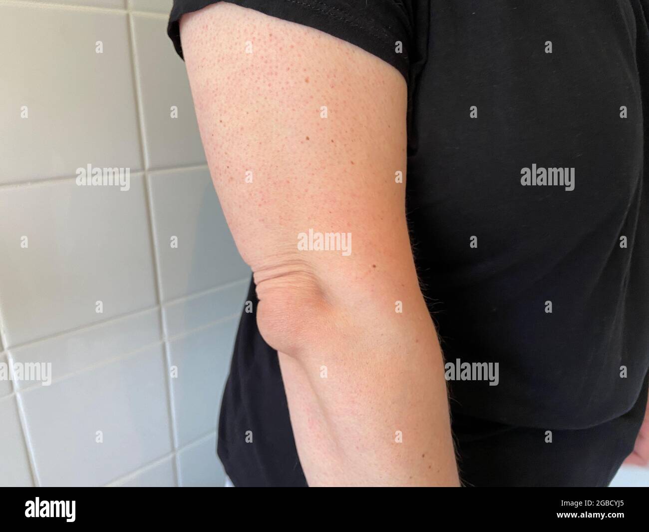 Olecranon Bursitis wird manchmal als „Popeye-Ellenbogen“ bezeichnet. Bursitis ist eine ...