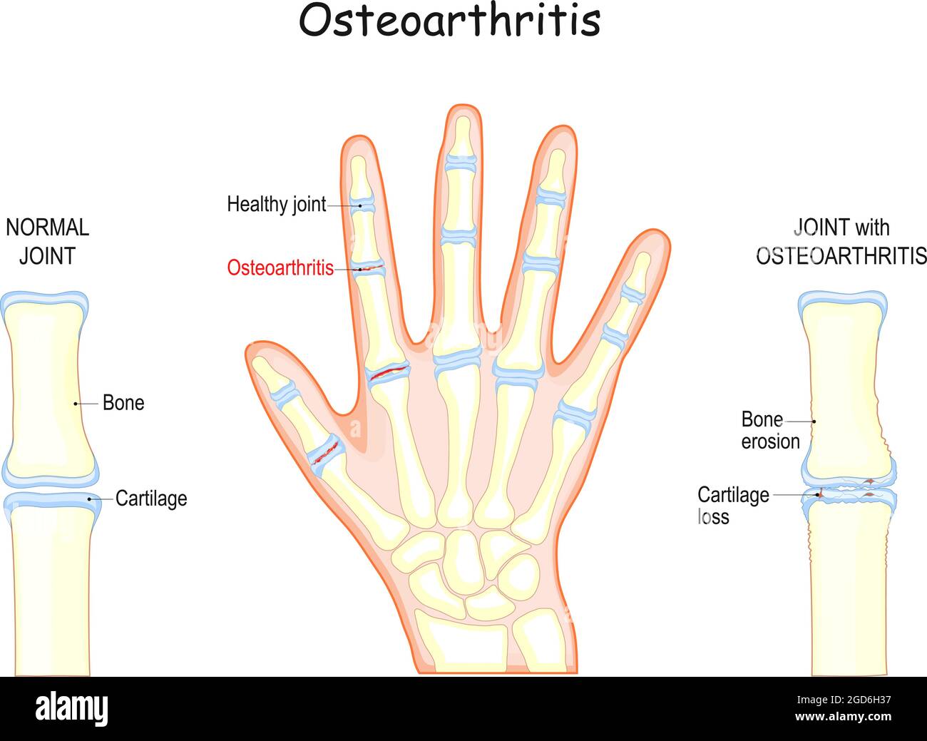 Arthrose. Knochen einer menschlichen Hand. Nahaufnahme eines normalen ...