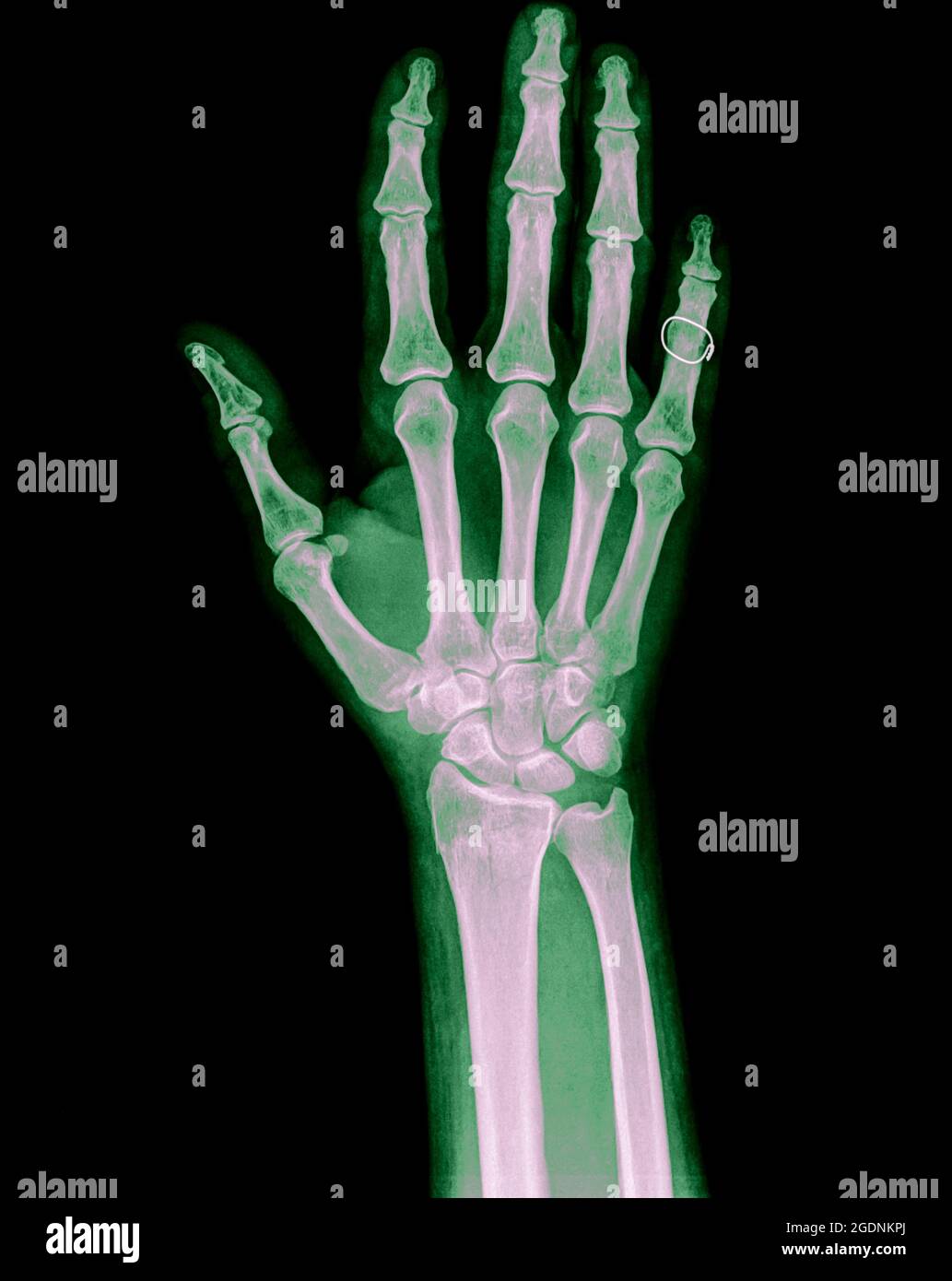 Röntgenaufnahme von Handgelenk, Hand und Fingern eines 64 Jahre alten ...