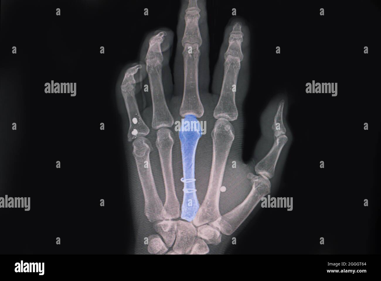 Third metacarpal fracture -Fotos und -Bildmaterial in hoher Auflösung ...