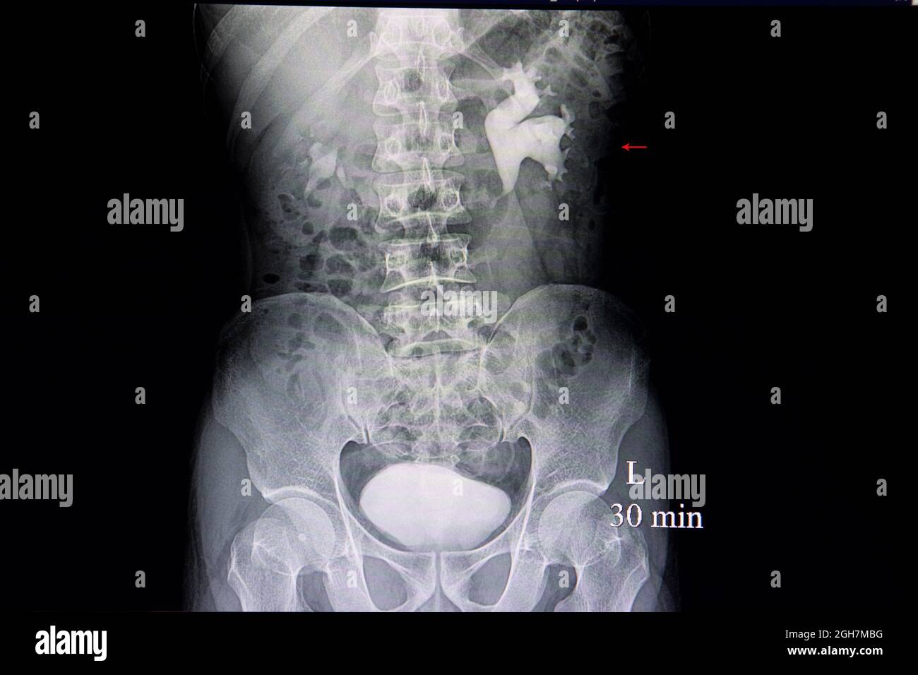 Intravenöser Pyelogramm-Röntgenfilm eines Patienten mit Hydronephrose ...