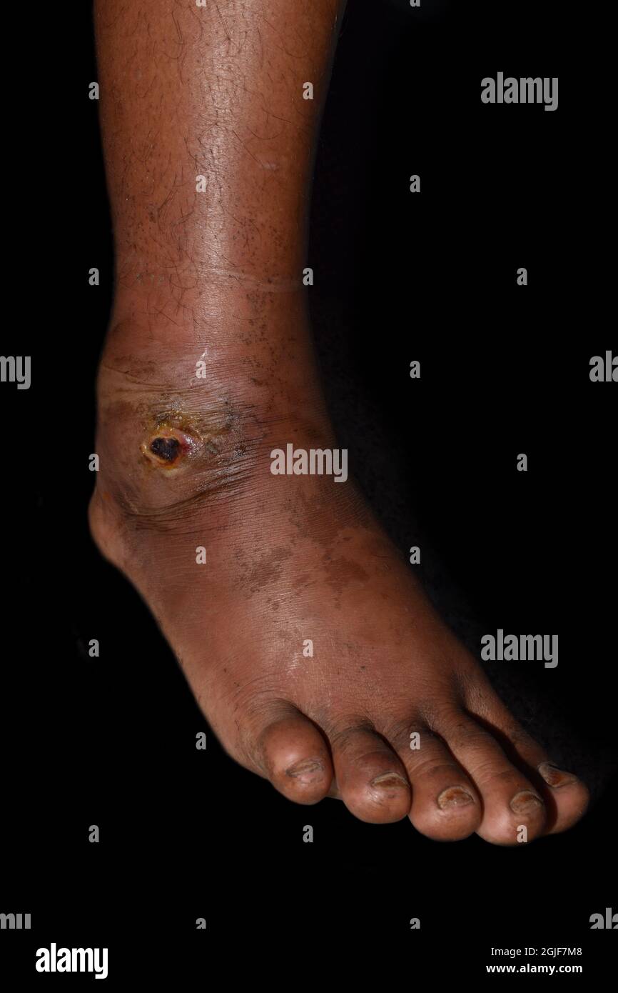 Geschwollener abszess -Fotos und -Bildmaterial in hoher Auflösung – Alamy