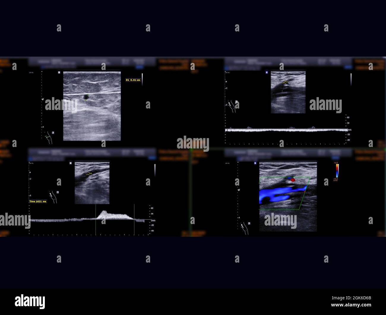 Ultraschall-doppler zur Diagnose tiefer Venenthrombose Krankheit der ...
