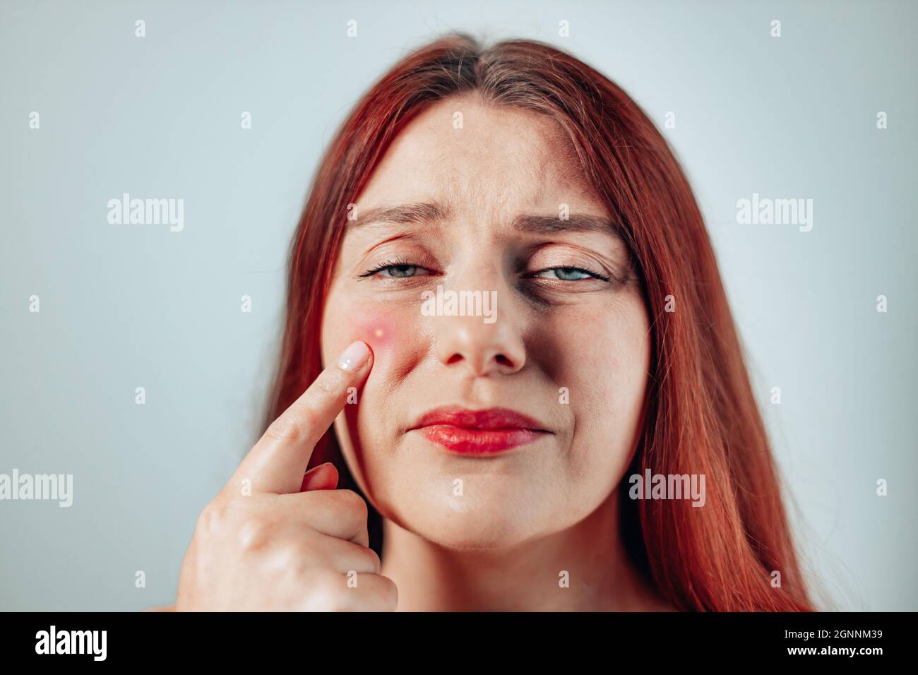 Eiterpickel im gesicht -Fotos und -Bildmaterial in hoher Auflösung – Alamy