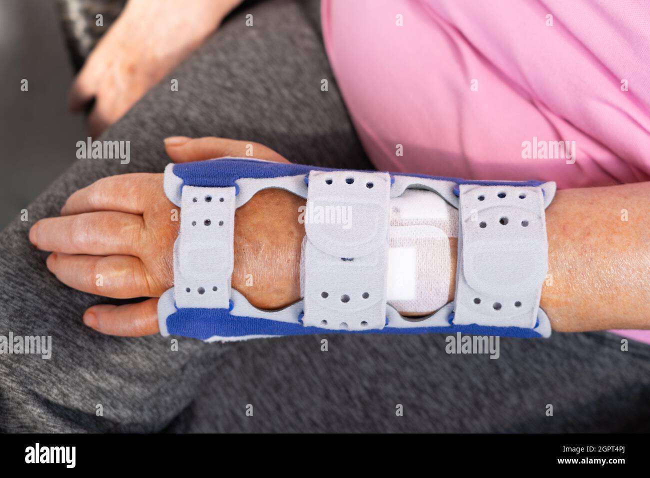 Gebrochener arm gegossen Stockfotos und -bilder Kaufen - Alamy