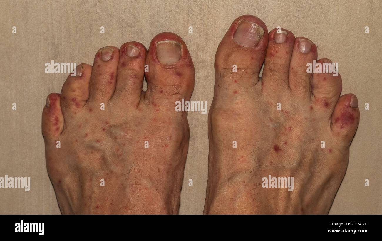 Scharlach epidemie -Fotos und -Bildmaterial in hoher Auflösung – Alamy