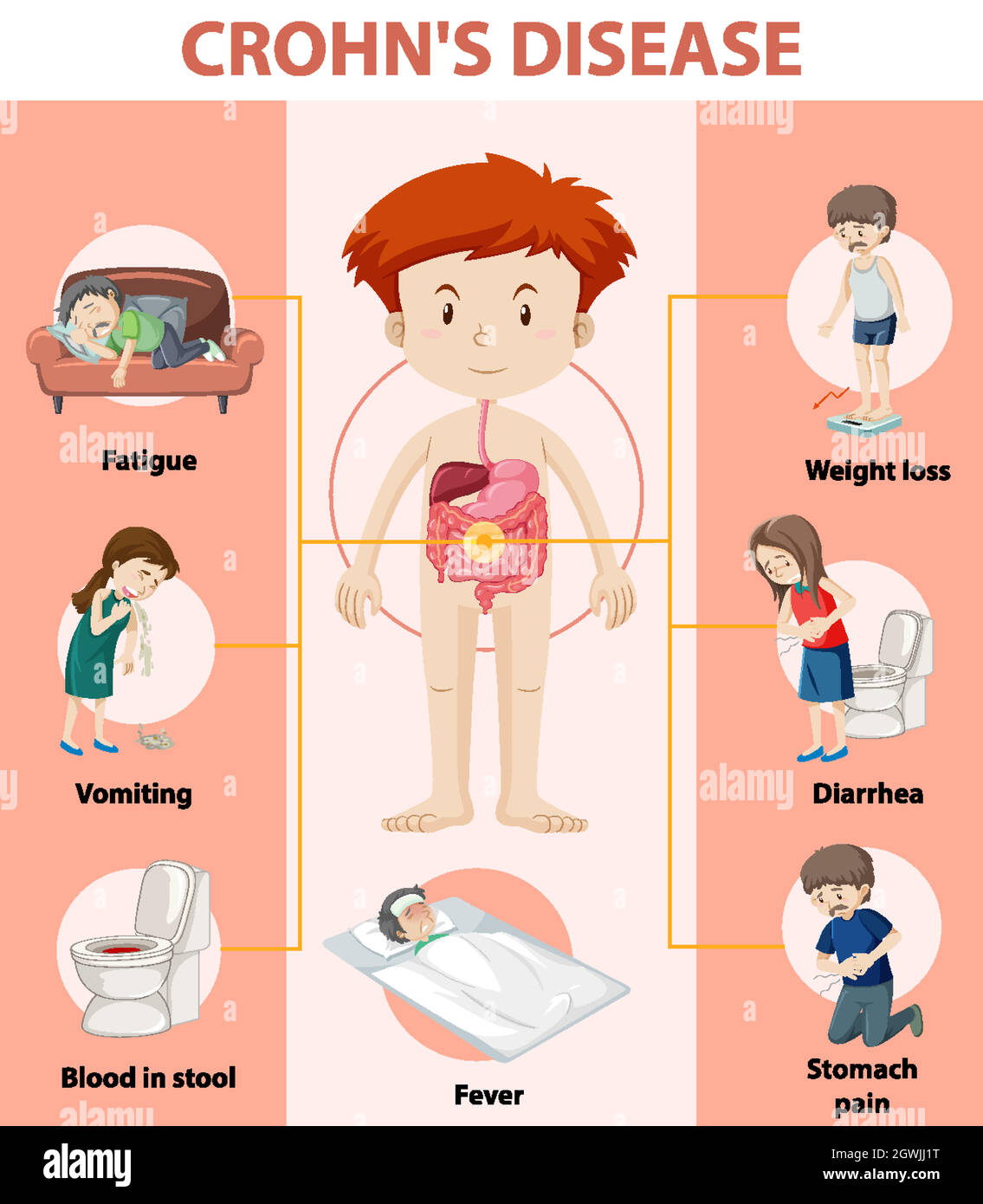 Morbus Crohn Stockfotos und -bilder Kaufen - Alamy