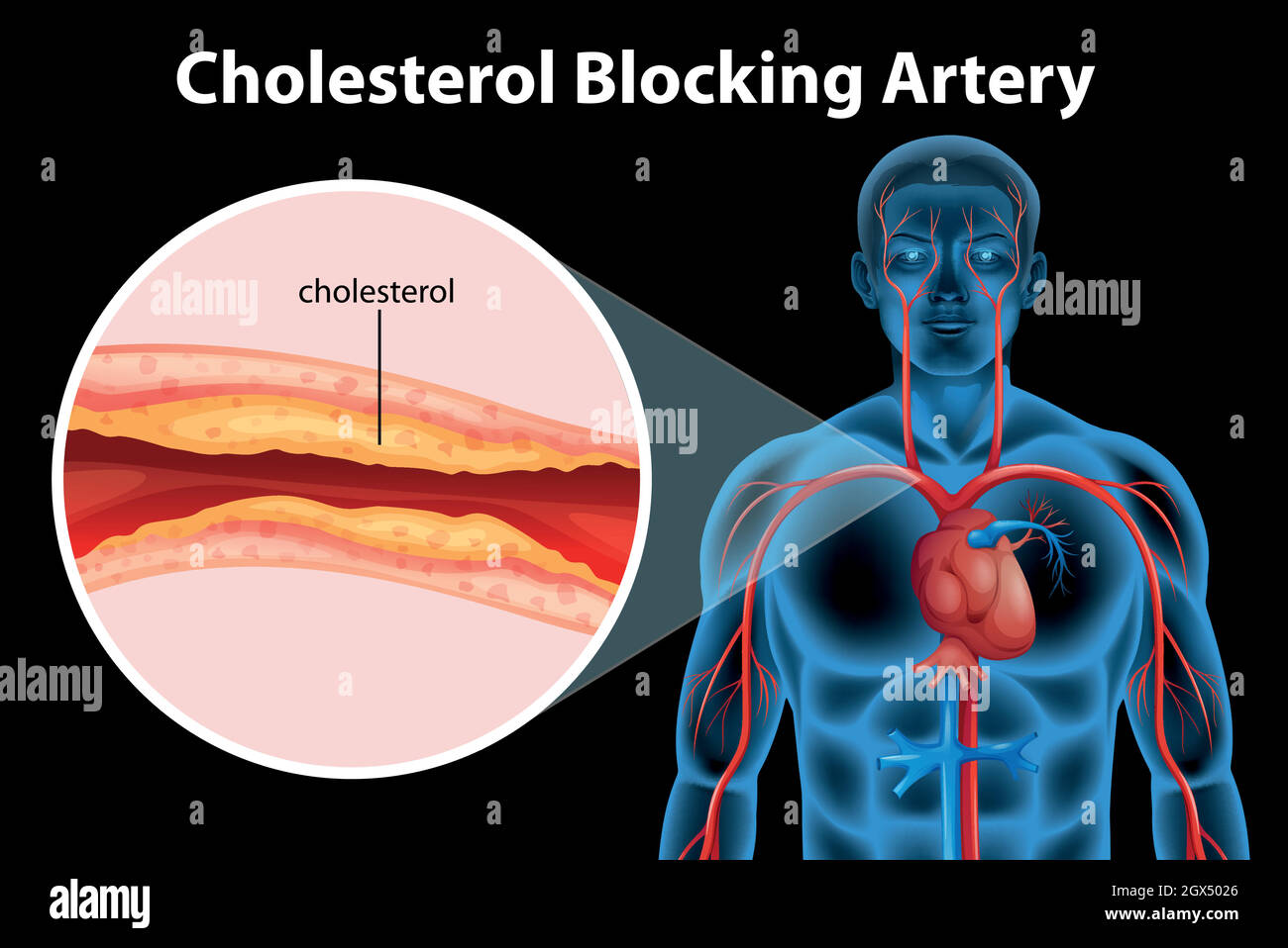 Artery plaque Stock-Vektorgrafiken kaufen - Alamy