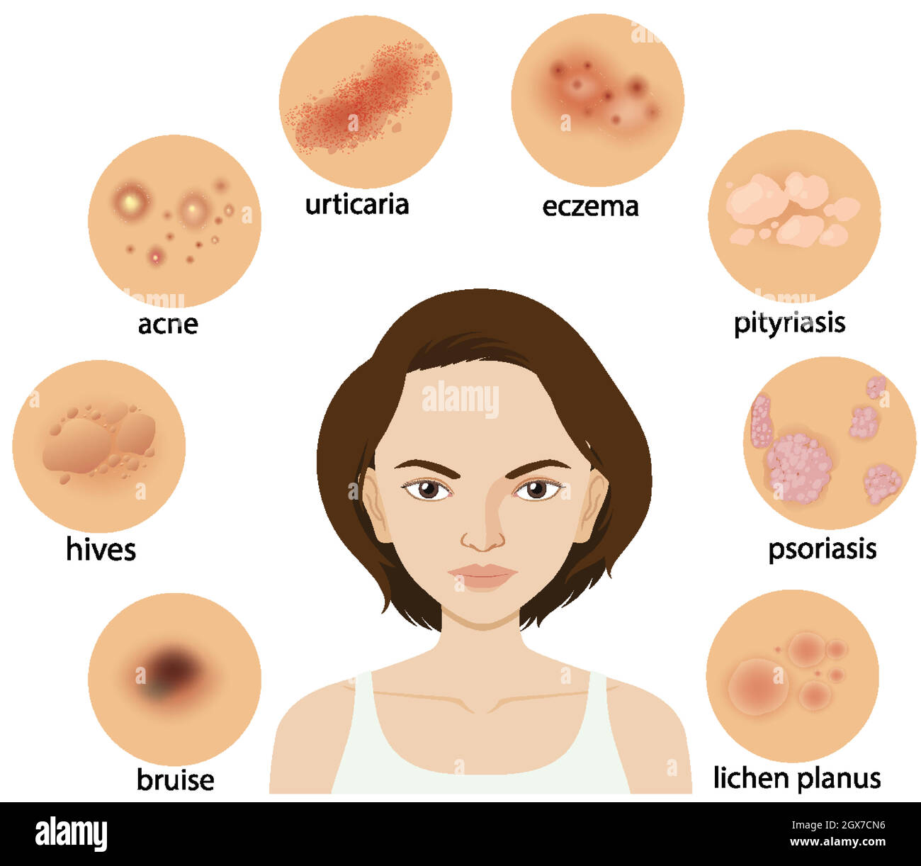 Diagramm mit unterschiedlichen Hautzuständen Stock-Vektorgrafik - Alamy