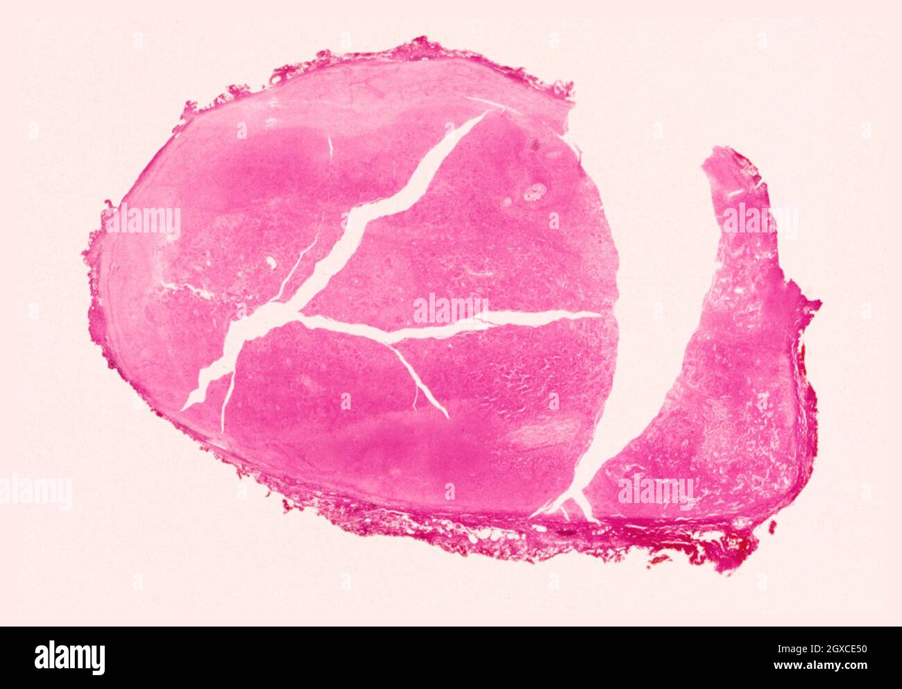 Histoplasmosis capsulatum histoplasma capsulatum -Fotos und ...