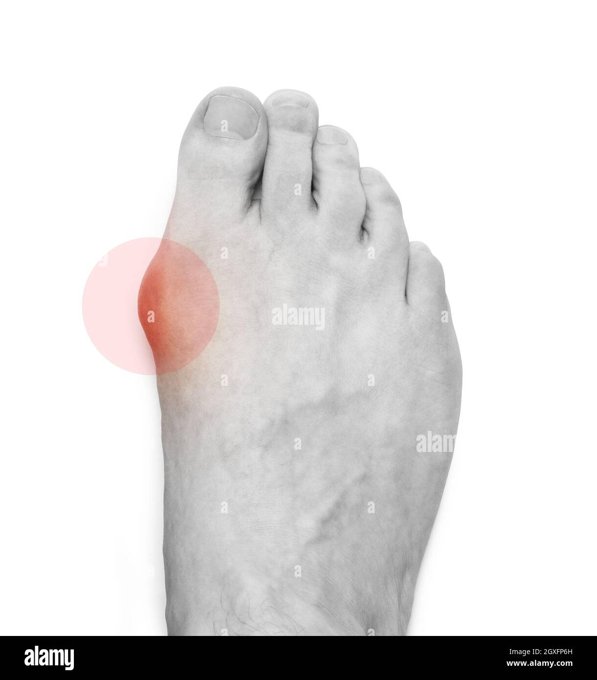 Hallux Varus Stockfotos und -bilder Kaufen - Alamy