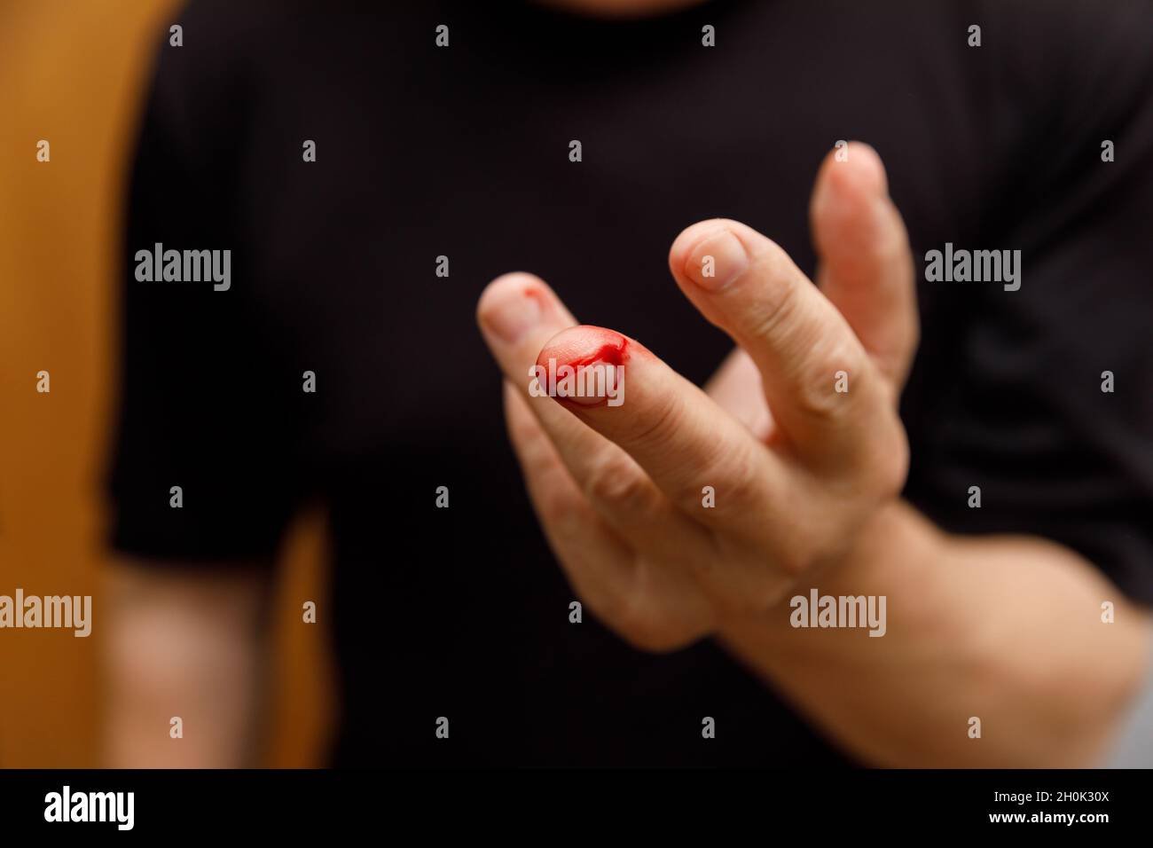 Hand fracture -Fotos und -Bildmaterial in hoher Auflösung - Seite 3 - Alamy