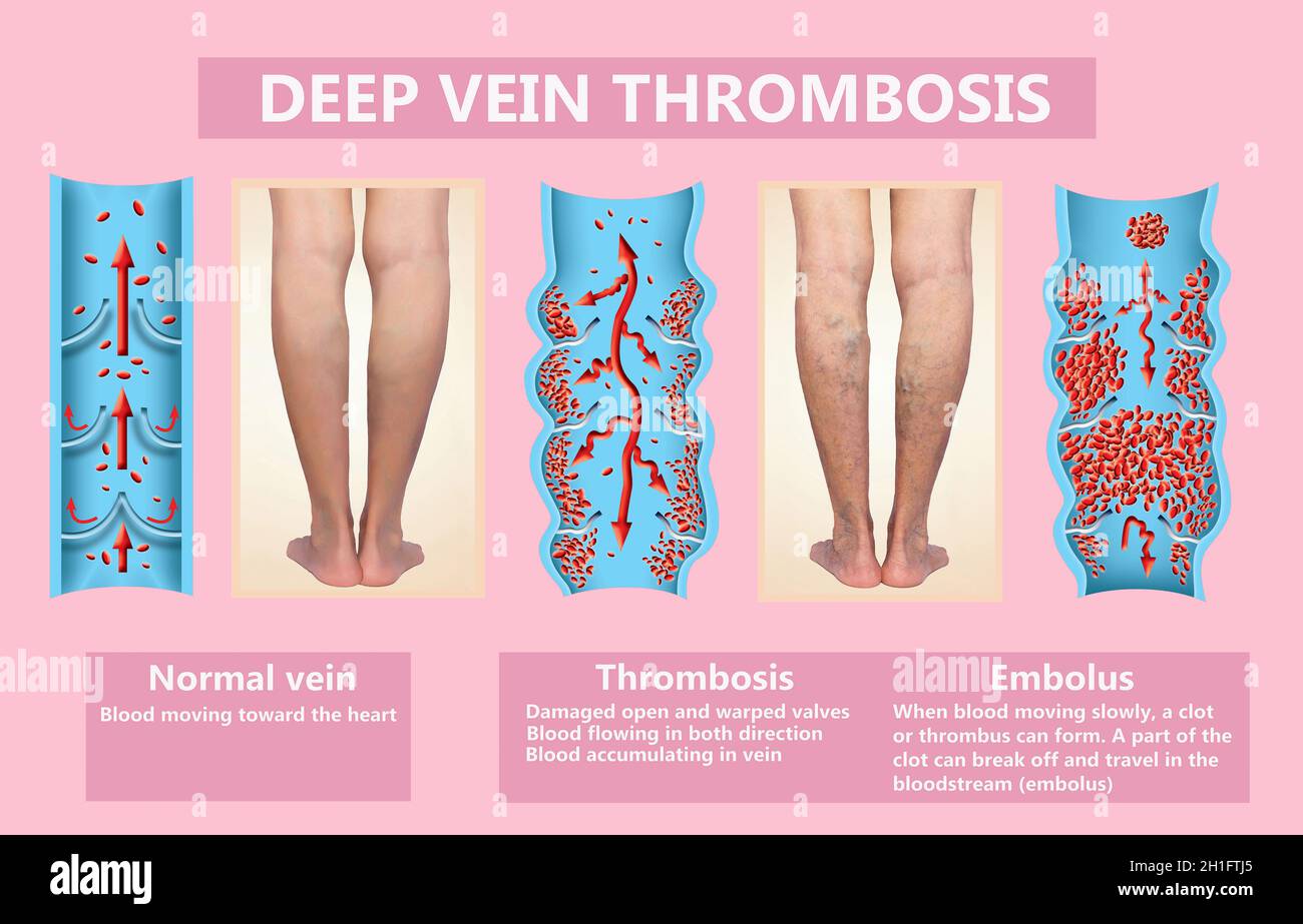 Tiefe Venenthrombose oder Blutgerinnsel. Embolus. Struktur der normalen ...