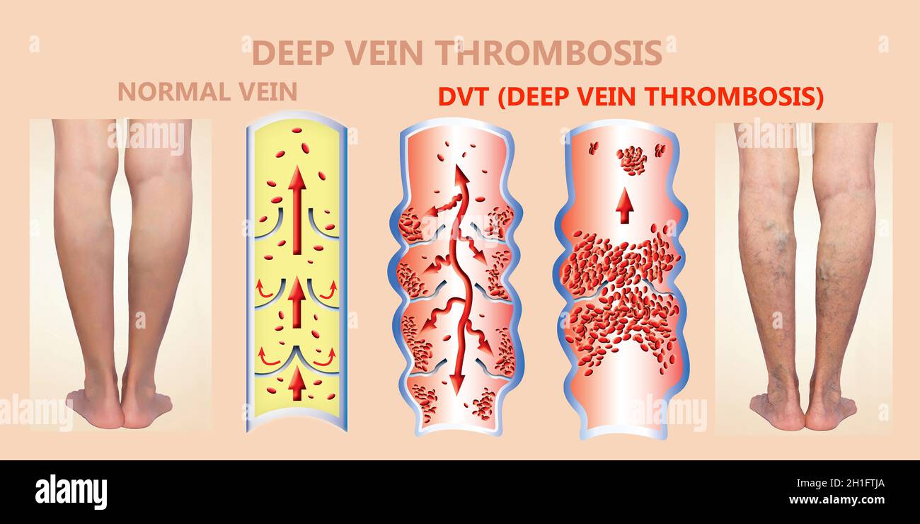 Tiefe Venenthrombose oder Blutgerinnsel. Embolus. Struktur der normalen ...