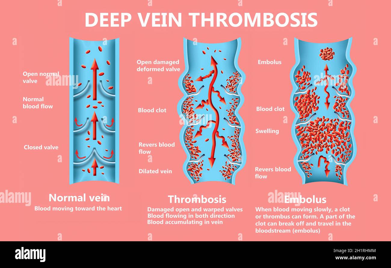 Thrombose venen illustration -Fotos und -Bildmaterial in hoher ...