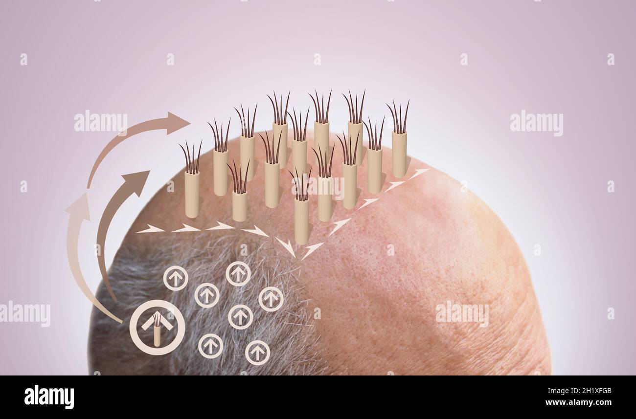 Methoden der Haartransplantation FUT und FuE fuge mit Transplantation ... Methoden der Haartransplantation FUT und FuE fuge mit Transplantation ...