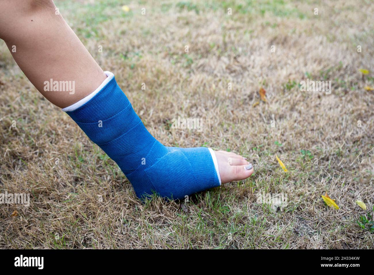 Gipsbein frau -Fotos und -Bildmaterial in hoher Auflösung – Alamy