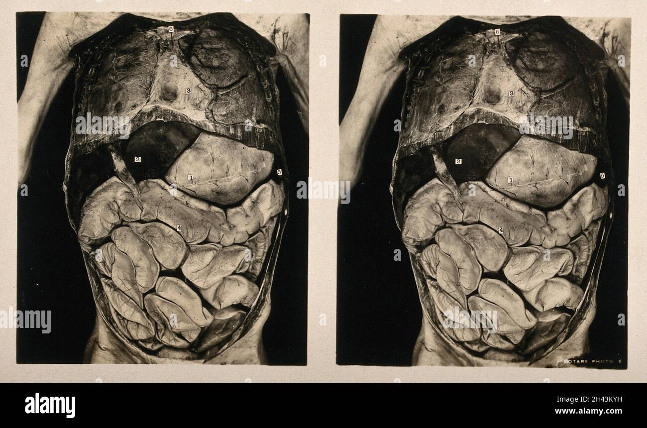 Anatomie: Eine Dissektion des Abdomens, die die Bauchhöhle zeigt. Foto ...