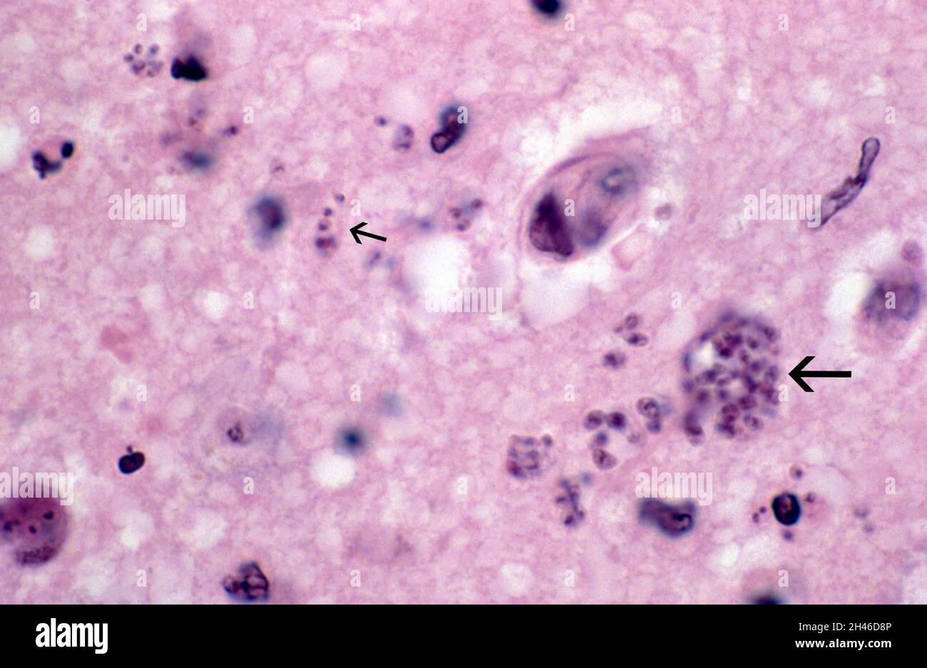 Toxoplasmose gehirn -Fotos und -Bildmaterial in hoher Auflösung – Alamy