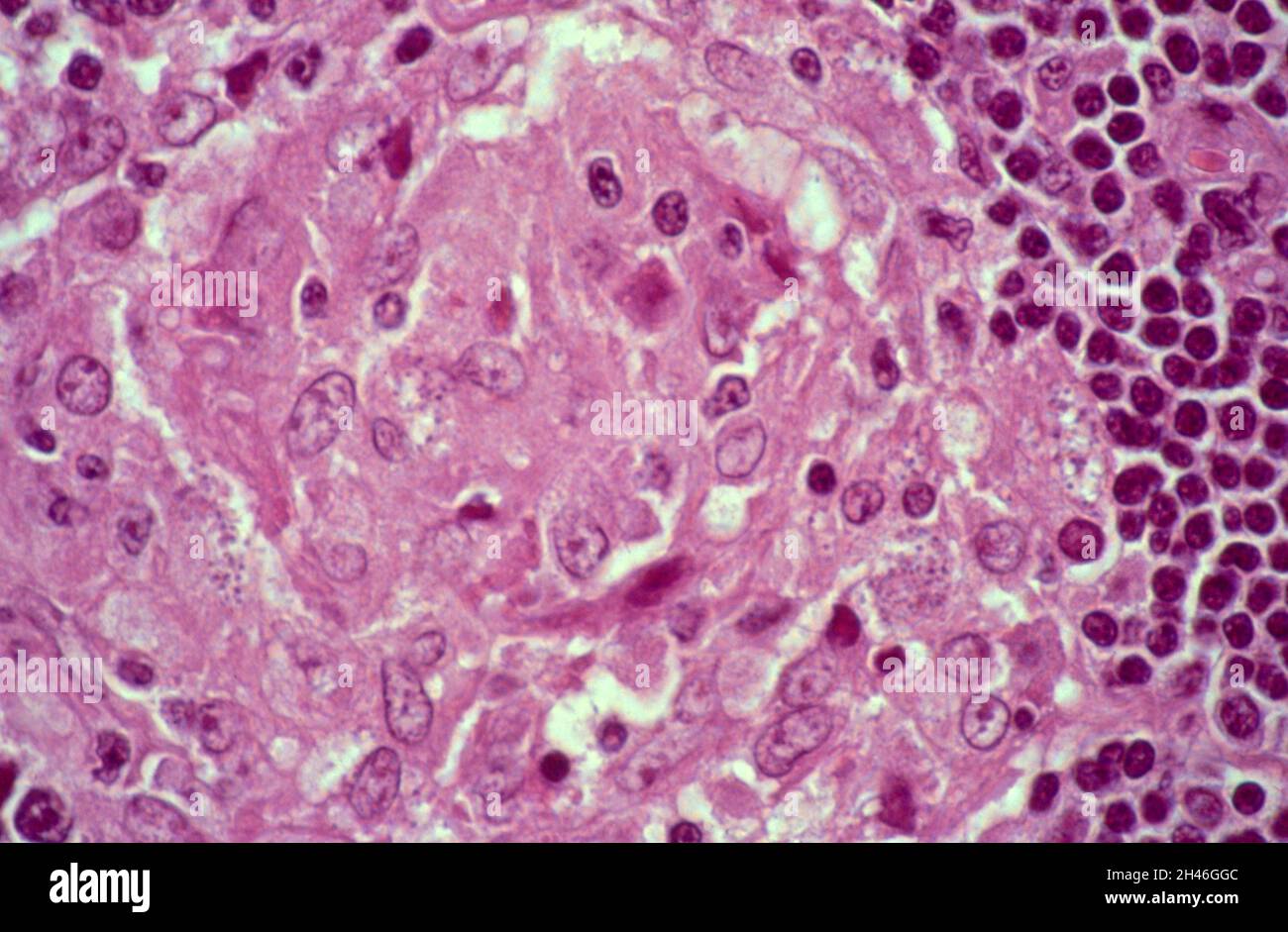 Leishmaniose mensch -Fotos und -Bildmaterial in hoher Auflösung – Alamy