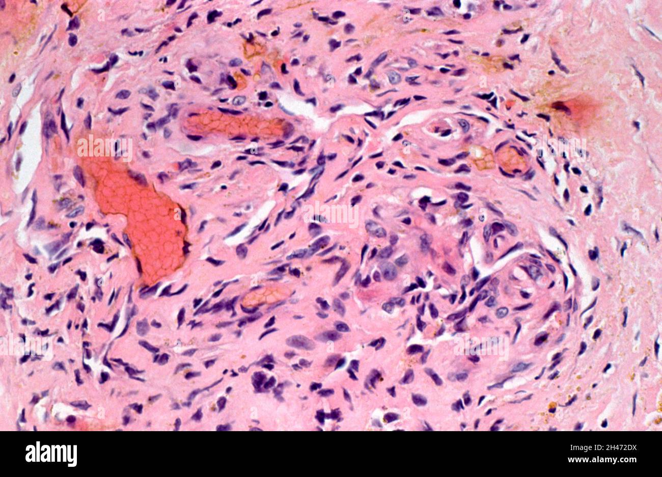 Kaposi's sarcoma -Fotos und -Bildmaterial in hoher Auflösung – Alamy