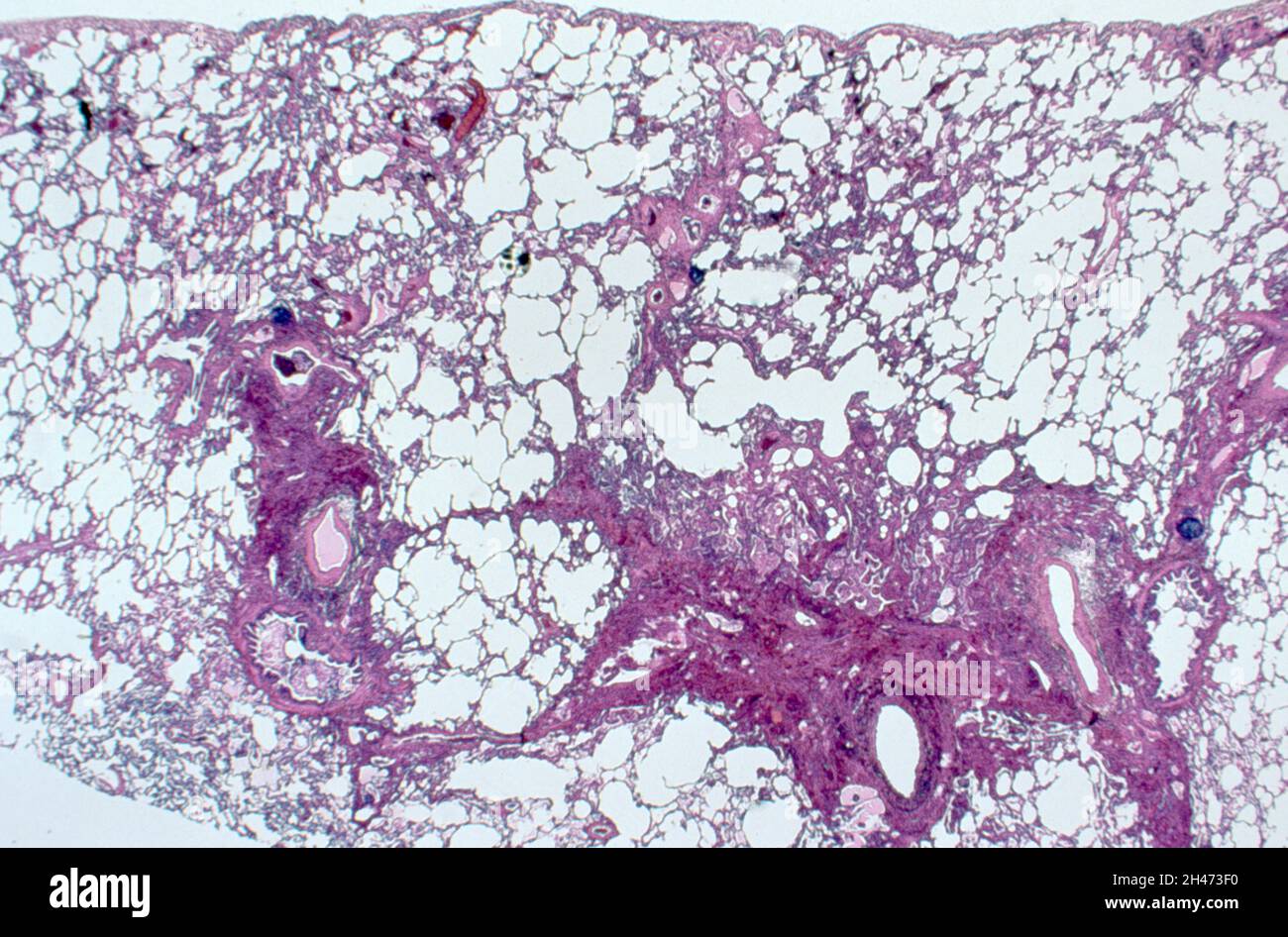 Kaposi's sarcoma -Fotos und -Bildmaterial in hoher Auflösung – Alamy