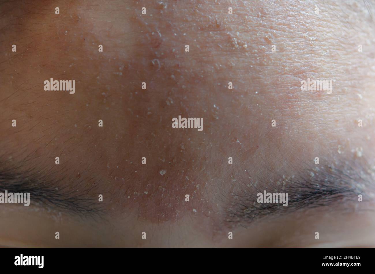 Dermatitis eczema face rash -Fotos und -Bildmaterial in hoher Auflösung ...