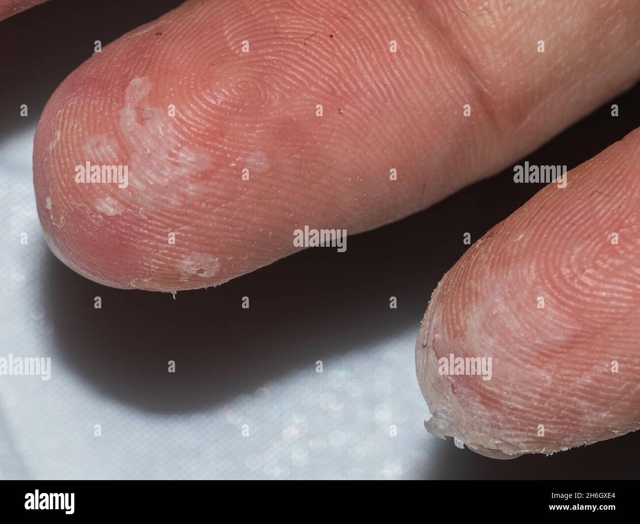 Scharlach epidemie -Fotos und -Bildmaterial in hoher Auflösung – Alamy
