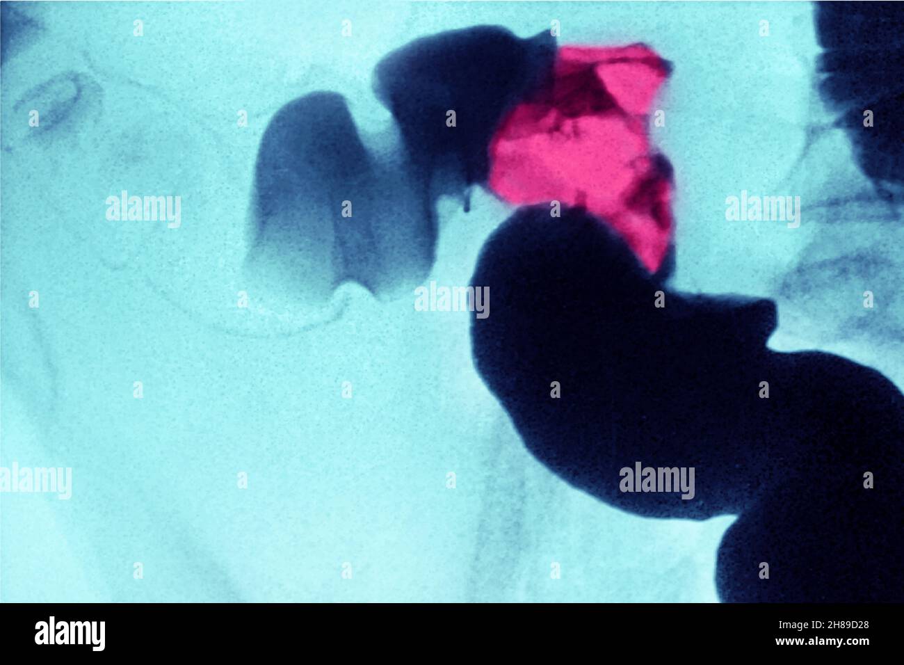 Colorectal cancer -Fotos und -Bildmaterial in hoher Auflösung – Alamy