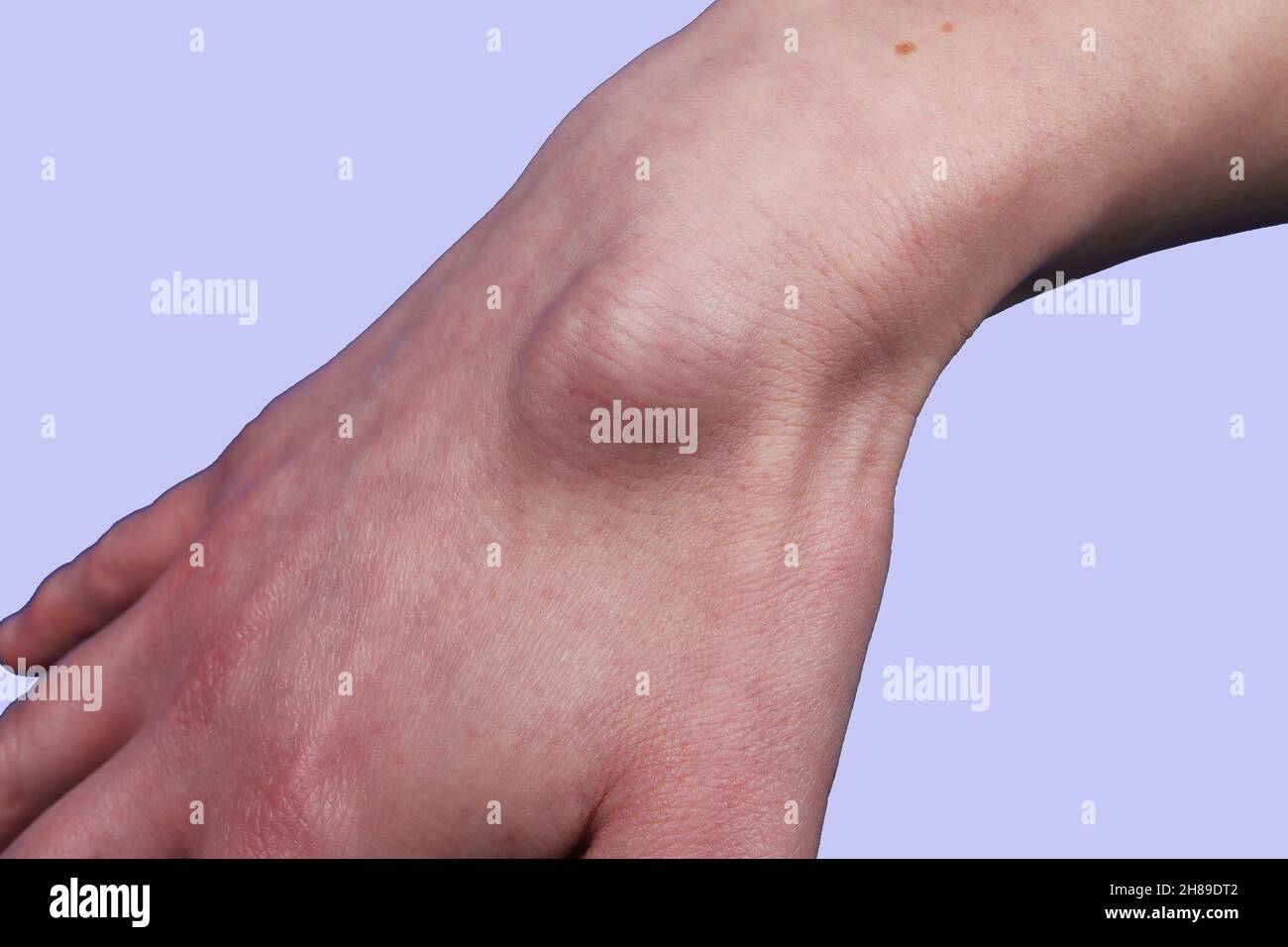 Synovial cyst -Fotos und -Bildmaterial in hoher Auflösung – Alamy