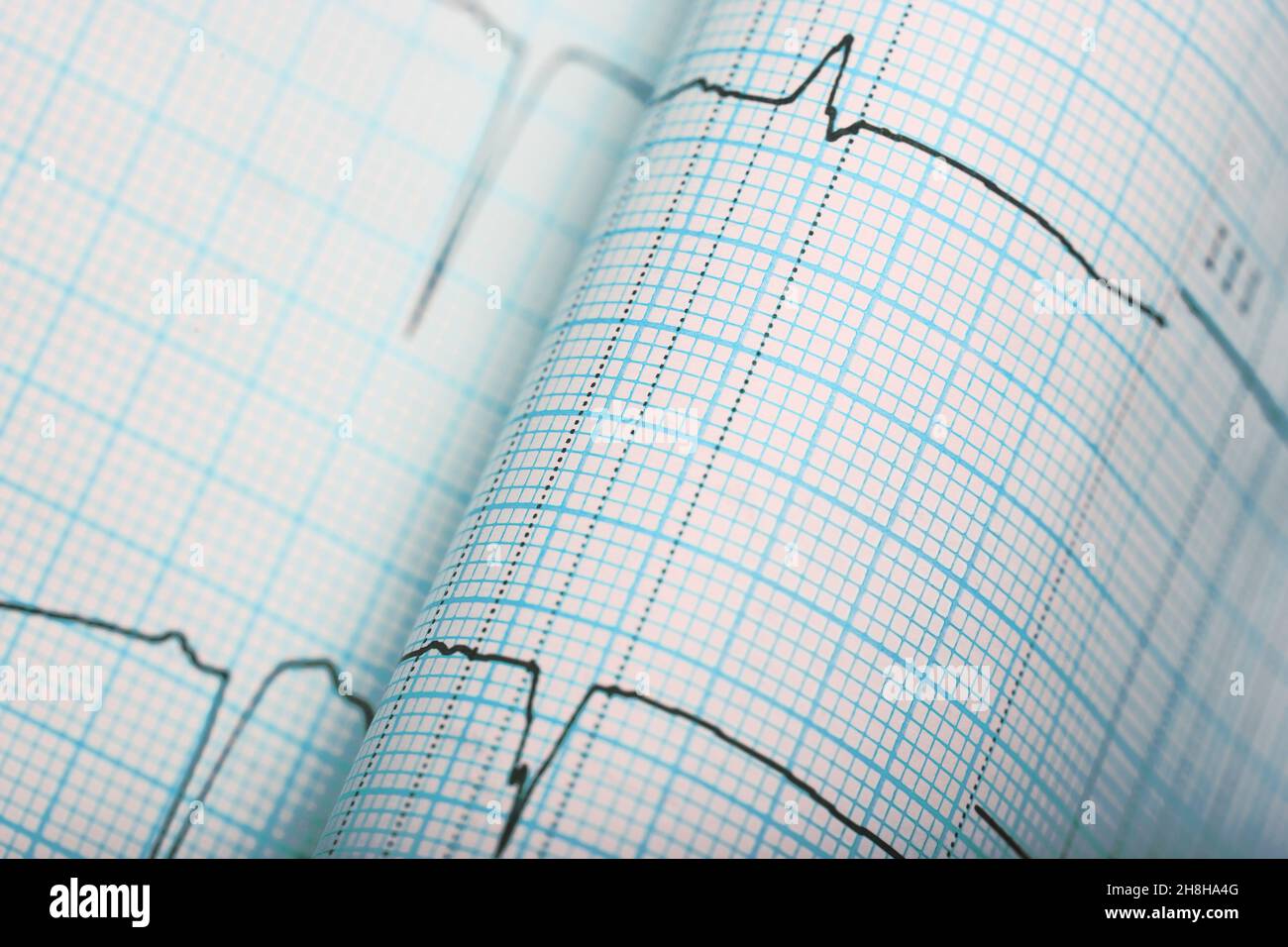 EKG-Linien auf dem gebogenen Diagrammpapier in Nahaufnahme ...