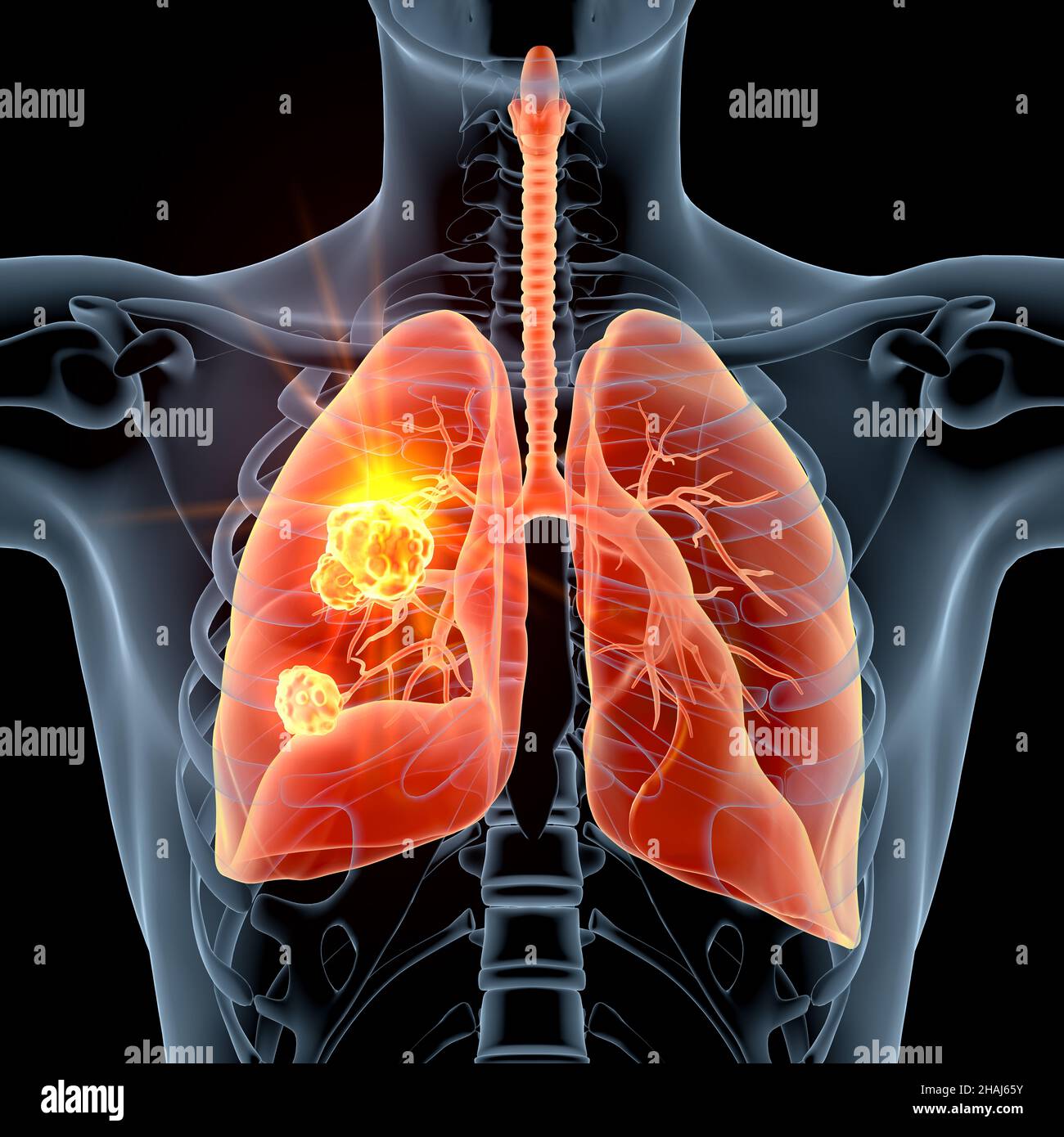 Hervorgehobenes Karzinom in der rechten Lunge, Abbildung 3D ...