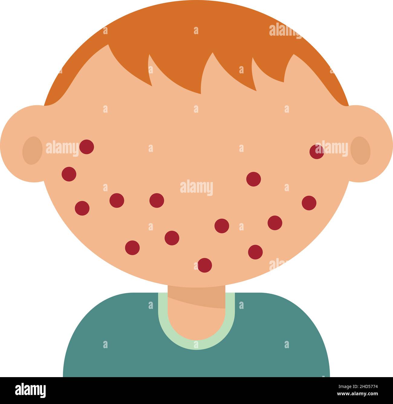 Chicken pox rash on face -Fotos und -Bildmaterial in hoher Auflösung ...