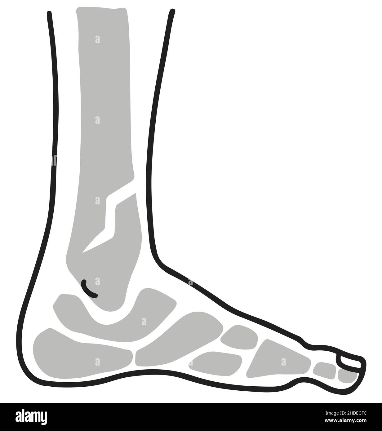 Knochenbruch. Doodle-Skizze. Abbildung des flachen Vektorgrafiks der ...