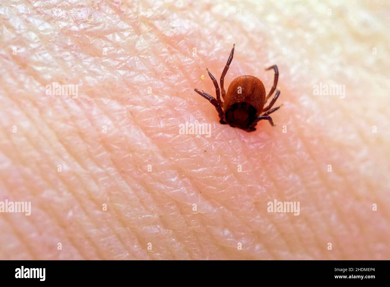 Zecke, Zeckenbiss, Zecken, Zeckenbiss Stockfotografie - Alamy