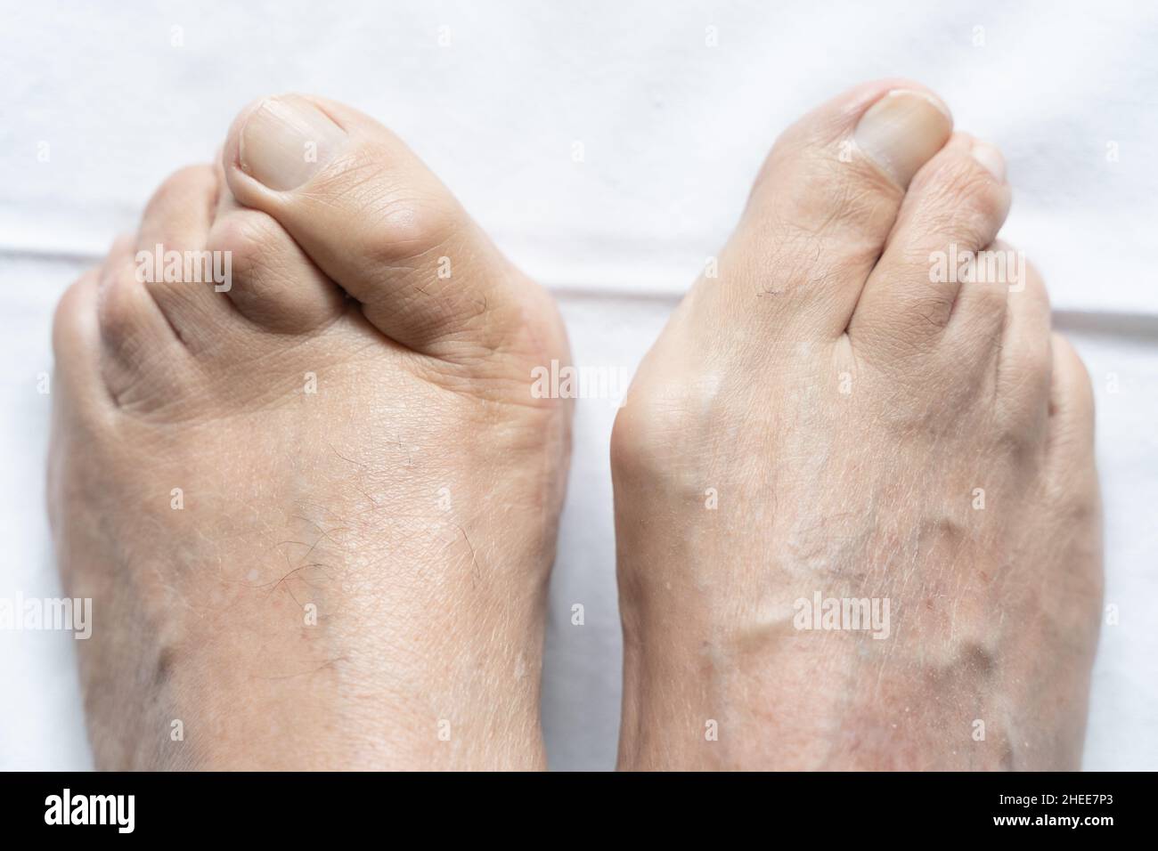 Eklige hässliche füße -Fotos und -Bildmaterial in hoher Auflösung – Alamy