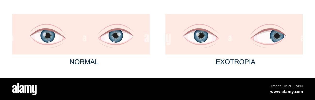 Exotropie. Horizontaler Strabismus vor und nach der Operation. Falsche ...