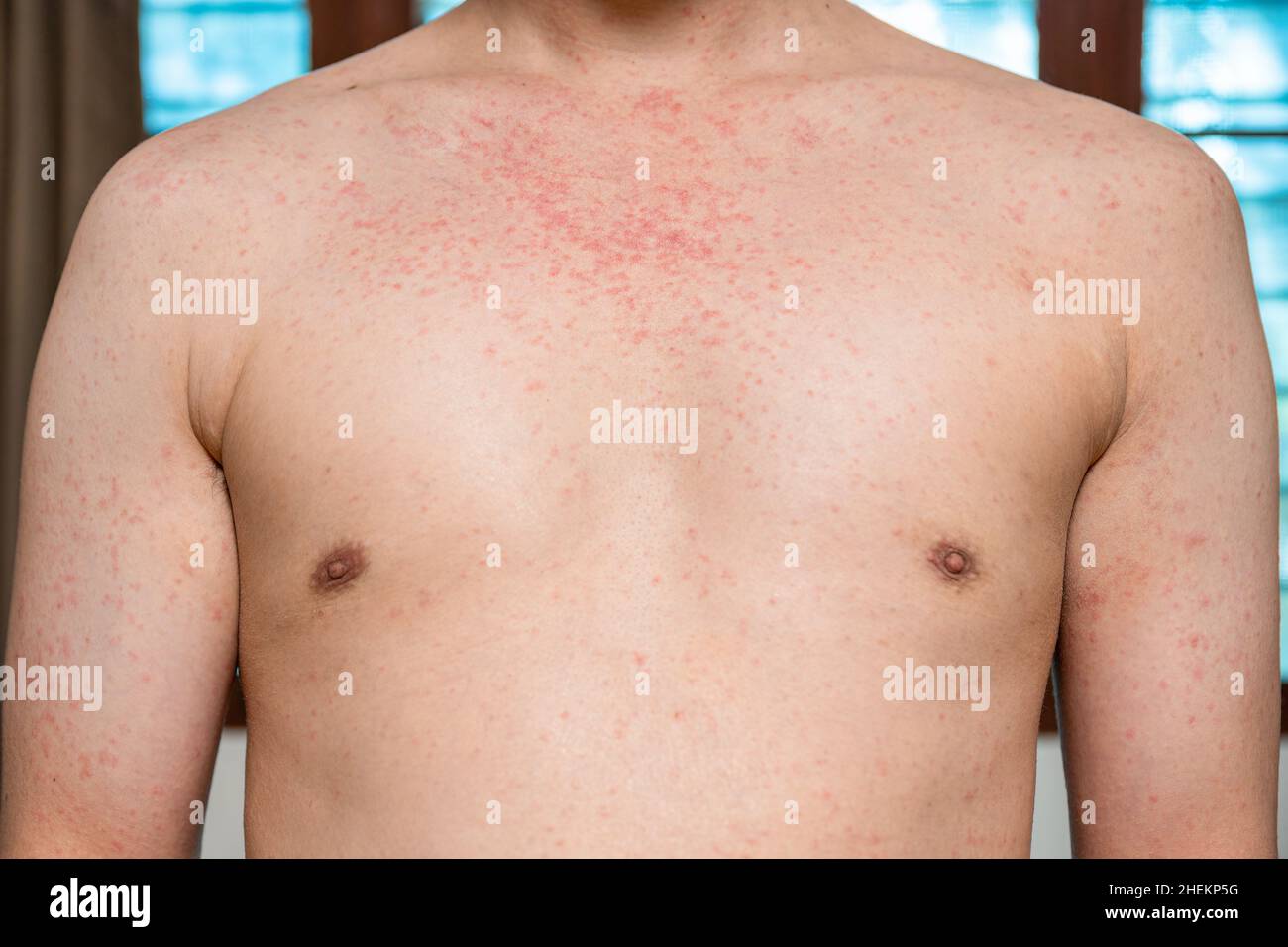 Dermatitis Hautausschlag Viruserkrankung mit Immunschwäche am Körper ...