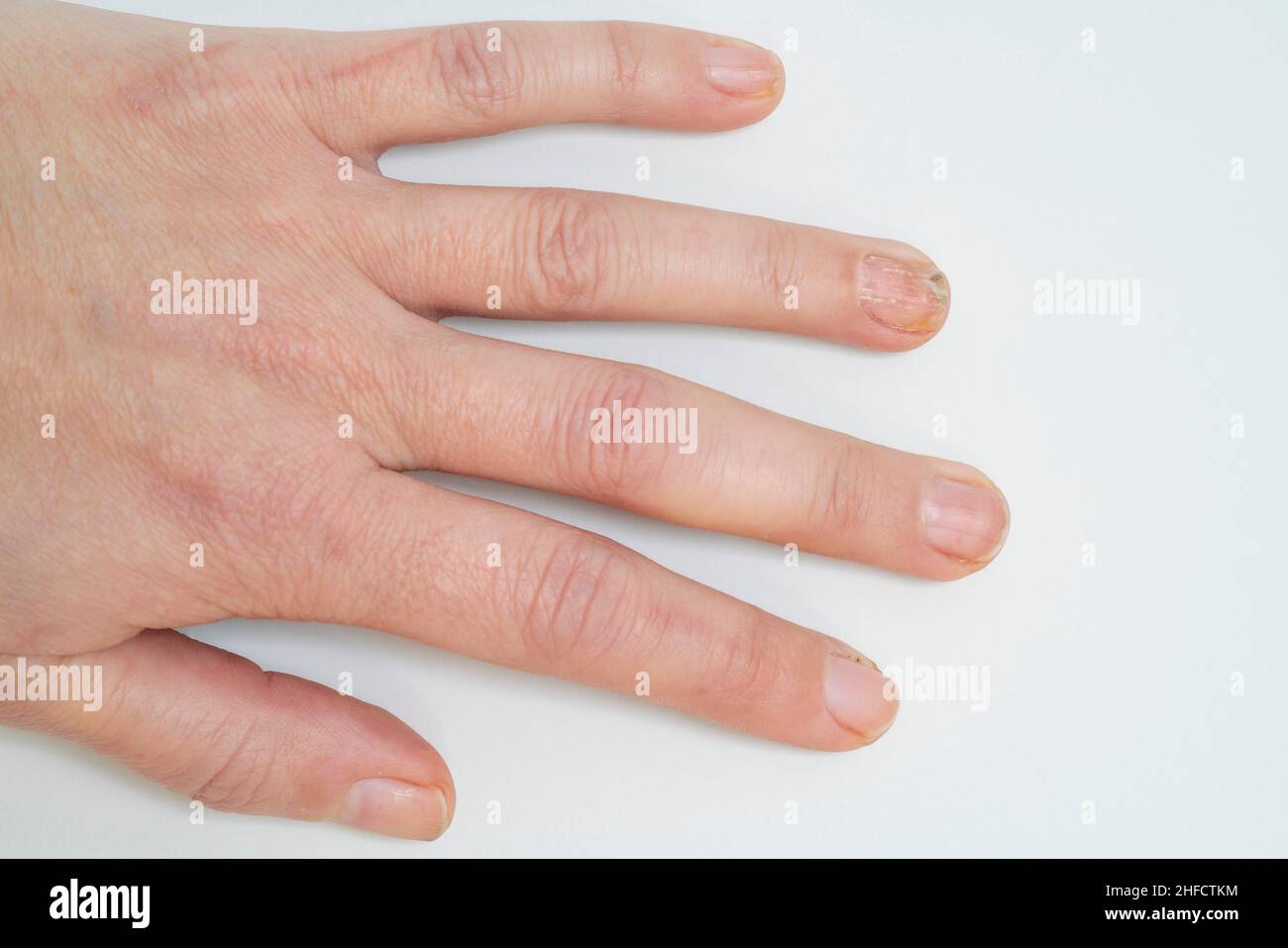 Nagelpilz finger -Fotos und -Bildmaterial in hoher Auflösung – Alamy
