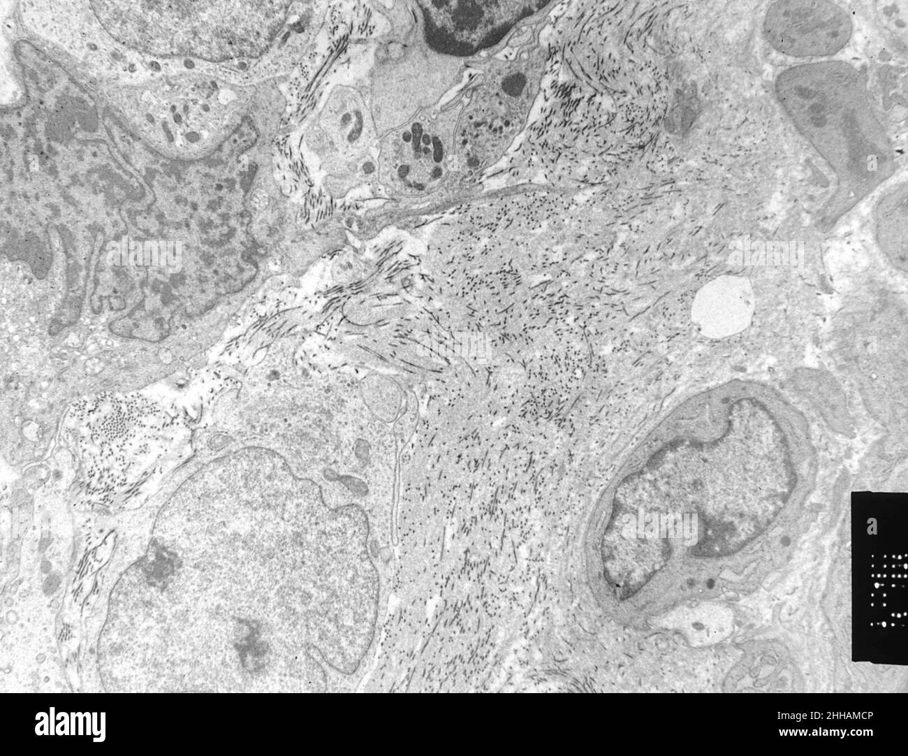 Soft tissue sarcoma -Fotos und -Bildmaterial in hoher Auflösung – Alamy