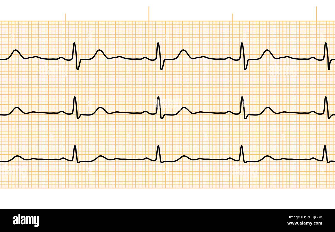herzschlag-ekg oder ekg nahtlose schwarze Linie auf orangefarbenem ...