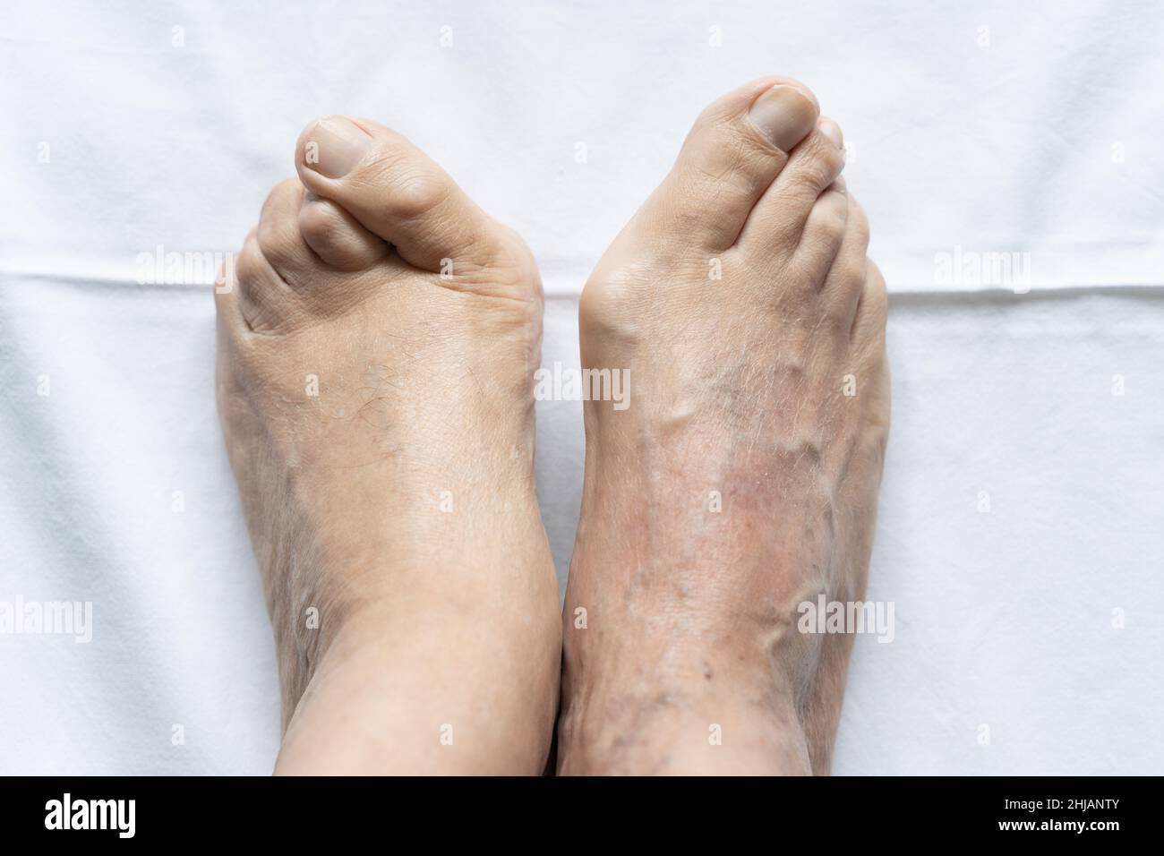 Füße eines älteren Mannes zusammen mit großen Bunions und Hammerzehen ...