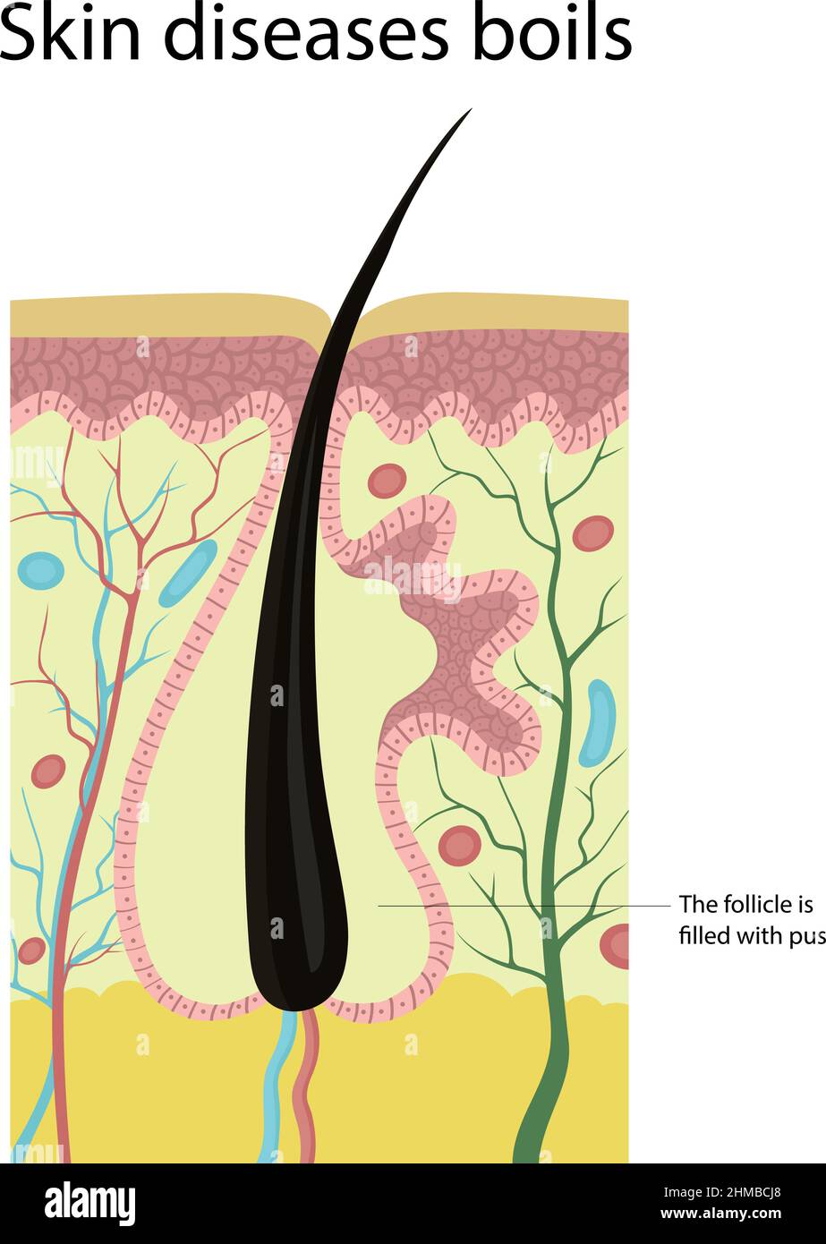 Vektor-Illustration der Haut Furunkel Krankheit. Der Follikel ist mit ...