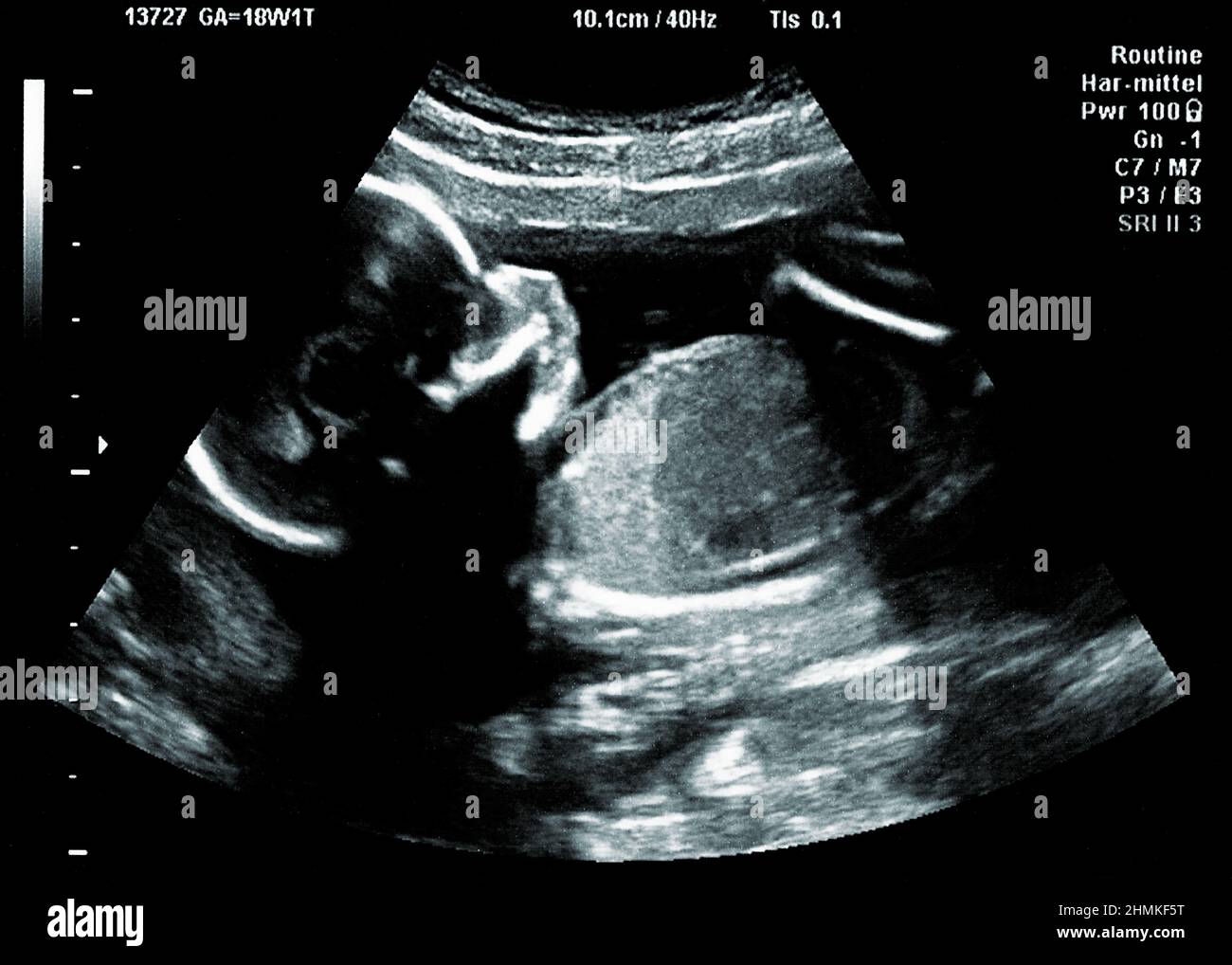 Baby kopf ultraschall -Fotos und -Bildmaterial in hoher Auflösung – Alamy