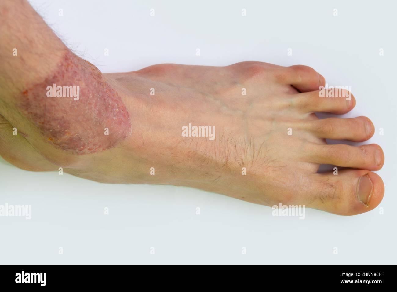 Der Fuß leidet in der akuten Phase der Allergie und Psoriasis an ...