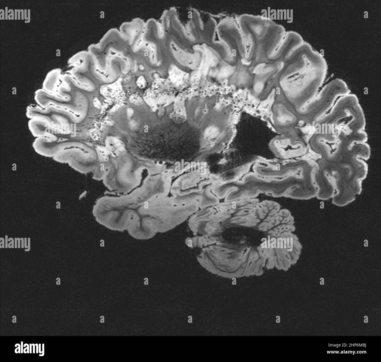 Mri von multipler sklerose Schwarzweiß-Stockfotos und -bilder - Alamy