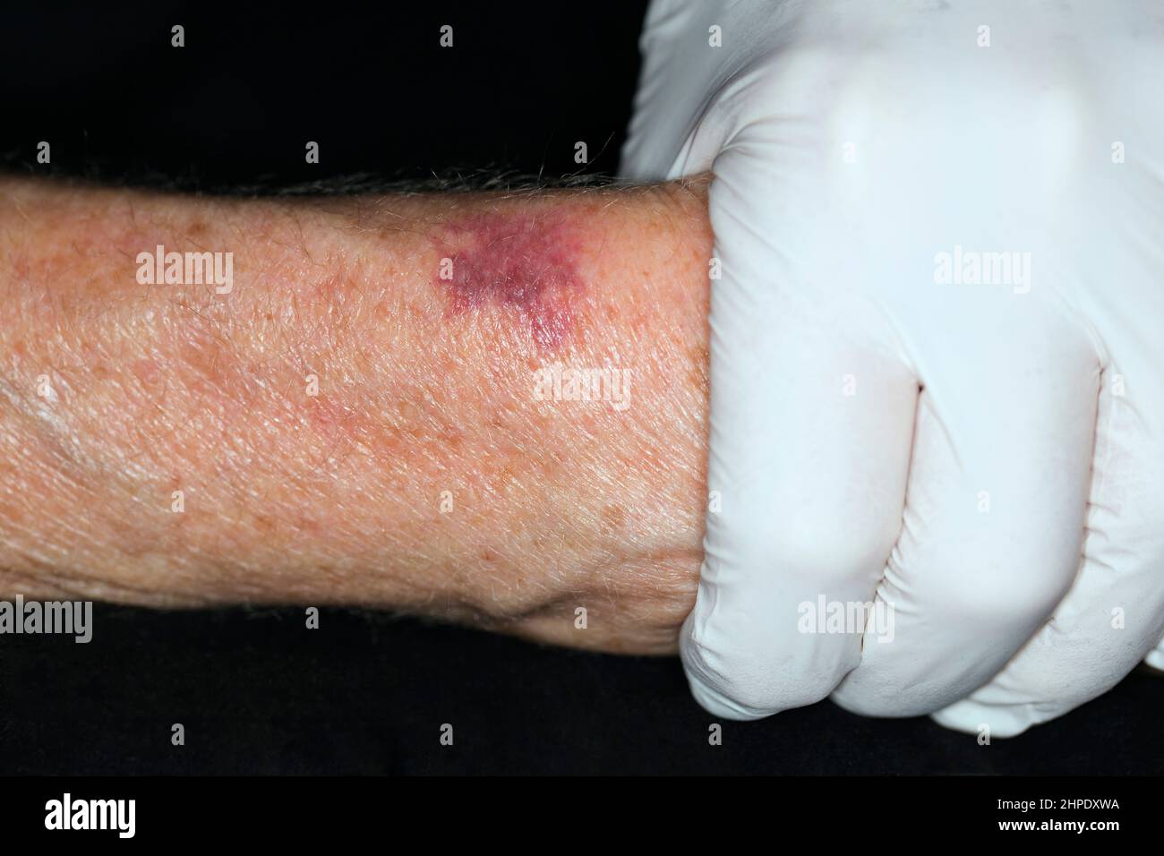 Senile purpura -Fotos und -Bildmaterial in hoher Auflösung – Alamy