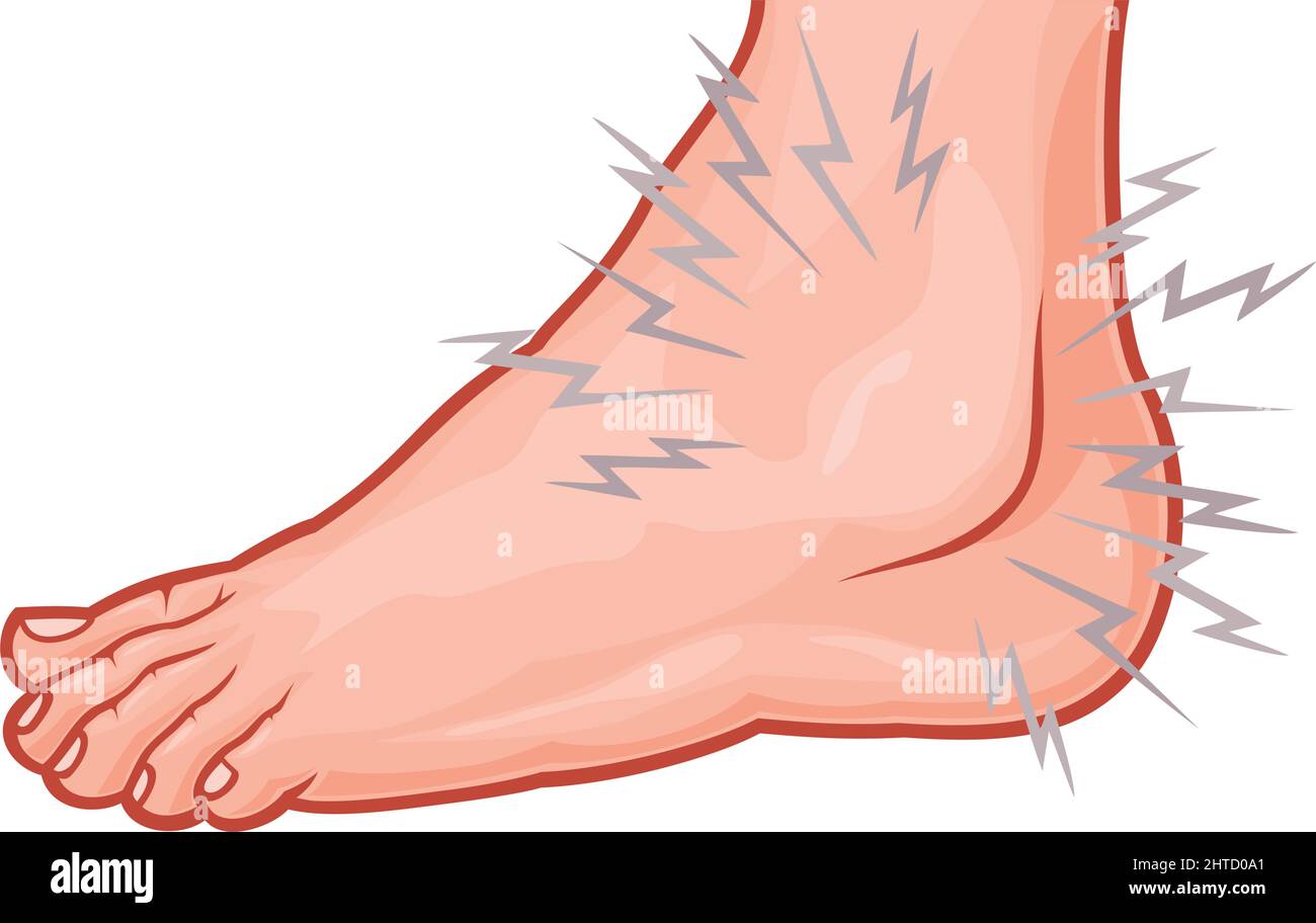 Verstaucht und geschwollen Stock-Vektorgrafiken kaufen - Alamy